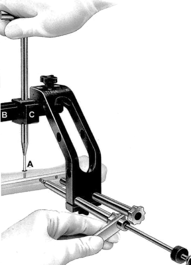 The effectiveness of the external distal aiming device in ...