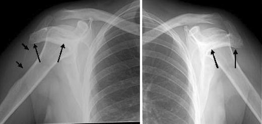 Deltoid contracture: a case with multiple muscle contractures ...