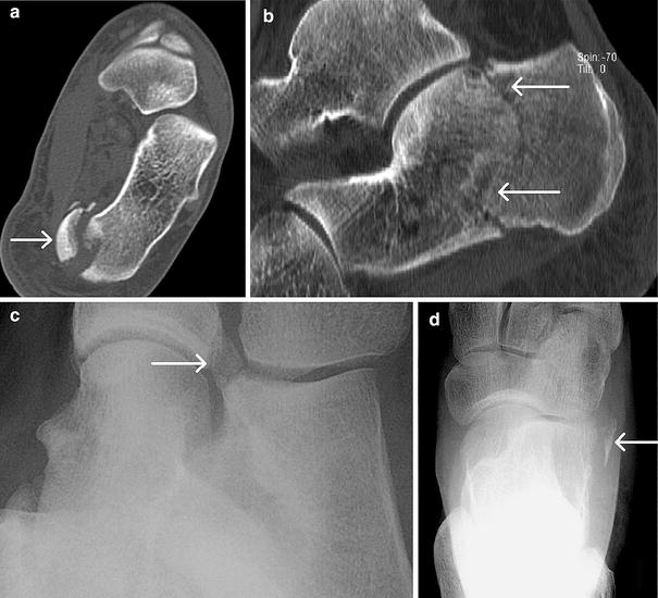 Demographics of extra-articular calcaneal fractures: including a review ...