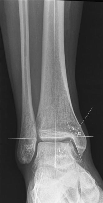 Direction of the oblique medial malleolar osteotomy for exposure of the ...
