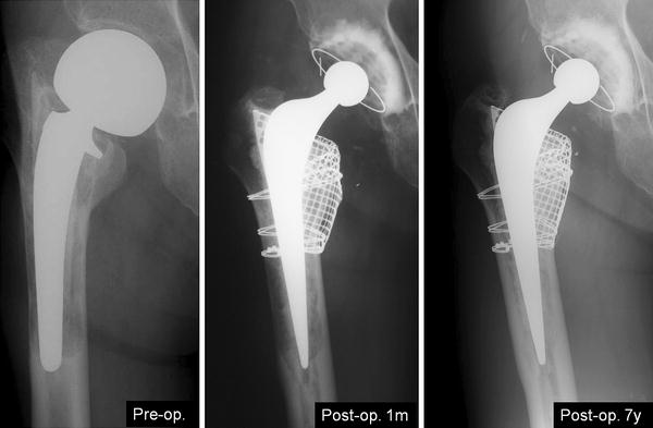 Impaction bone grafting for femoral revision hip arthroplasty with ...