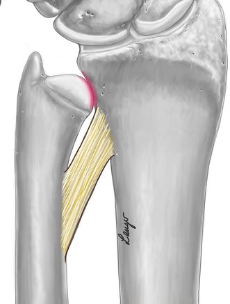 The distal radial decompression osteotomy for ulnar impingement ...