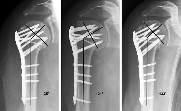 The relevance of neutral arm positioning for true ap-view X-ray to ...