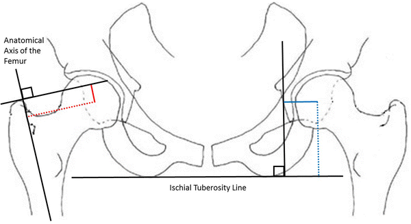Total hip replacement: increasing femoral offset improves functional ...