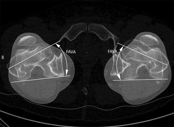 Acetabular overcoverage in the horizontal plane: an underdiagnosed ...