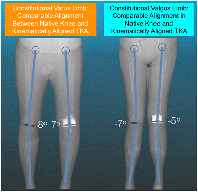 Does alignment of the limb and tibial width determine relative ...