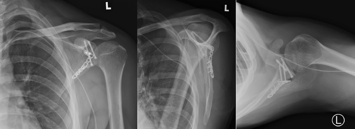 A Reverse Judet approach to the scapula | SpringerLink