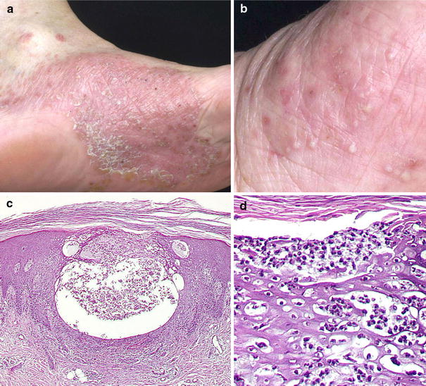 Manifestation of palmoplantar pustulosis during or after infliximab ...