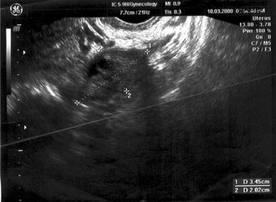 Primary ovarian adenomyoma in a woman with endometrial polyp: a case ...