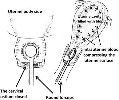 “Holding the cervix” technique: prophylaxis for acute recurrent uterine ...