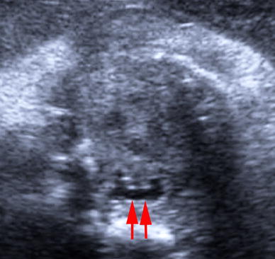 Bifid uvula and familial Stickler syndrome diagnosed prenatally before ...