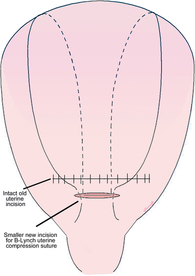 B-Lynch uterine compression sutures in the conservative surgical ...