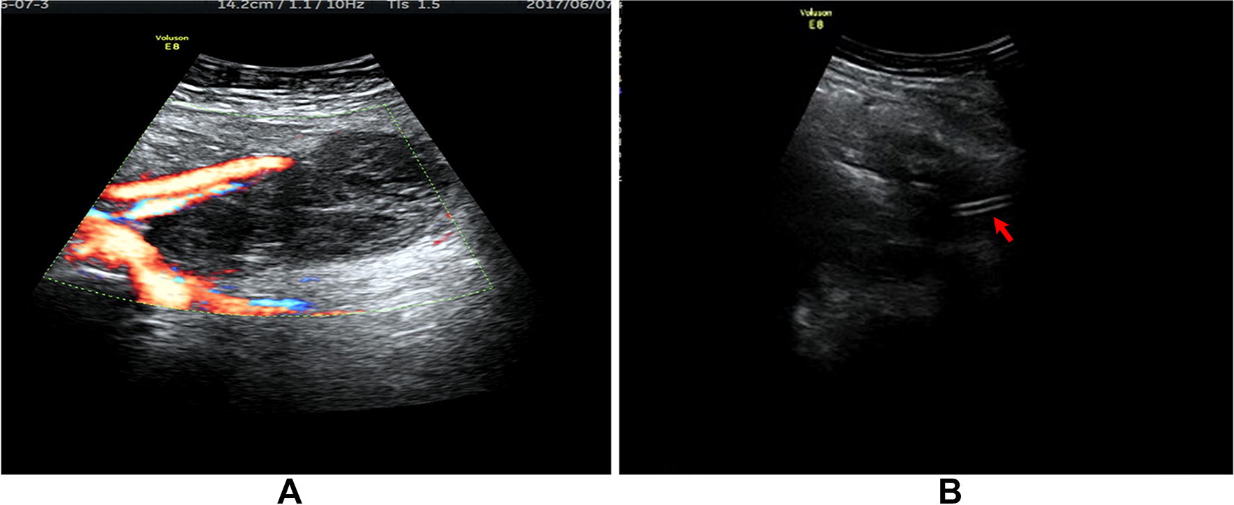 Risk factors, microbiology and management of infected lymphocyst after ...