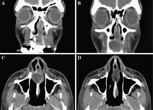 Nasal septal abscess: an unusual presentation of dentigerous cyst ...