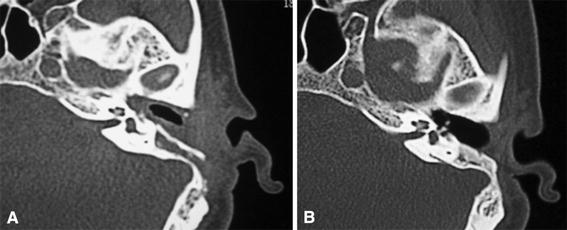 Canal wall reconstruction and mastoid obliteration with composite multi ...