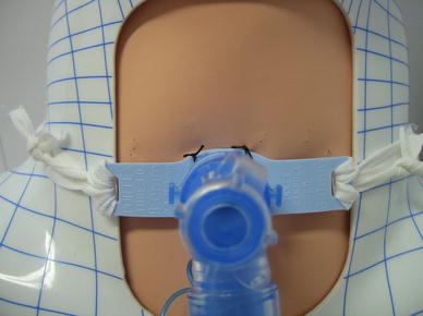How I do it: securing tracheostomy tubes | SpringerLink