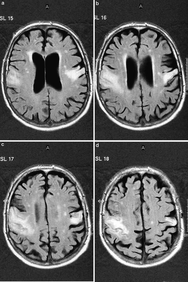 The effects of neuromuscular electrical stimulation for dysphagia in ...