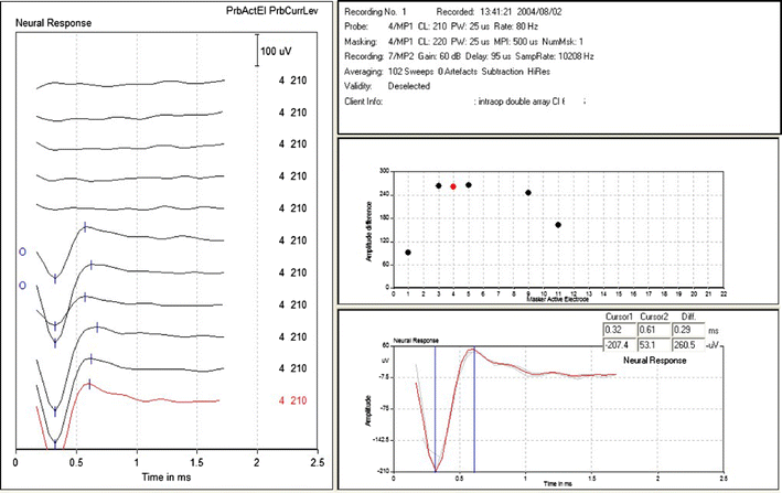 Neural response telemetry in patients with the double-array cochlear ...