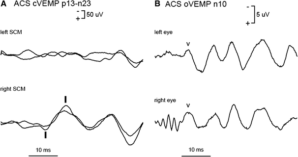 Dissociation between cVEMP and oVEMP responses: different vestibular ...