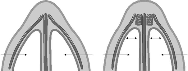 The value of spreader grafts in rhinoplasty: a critical review ...