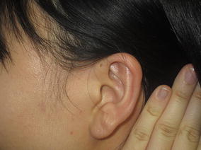 Early one-stage surgical treatment of infected preauricular sinus ...