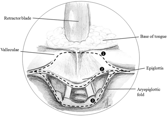 Transoral ultrasonic total laryngectomy (TOUSS-TL): description of a ...