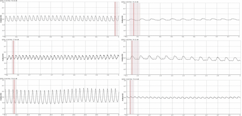 Electroglottography in the diagnosis of functional dysphonia | SpringerLink