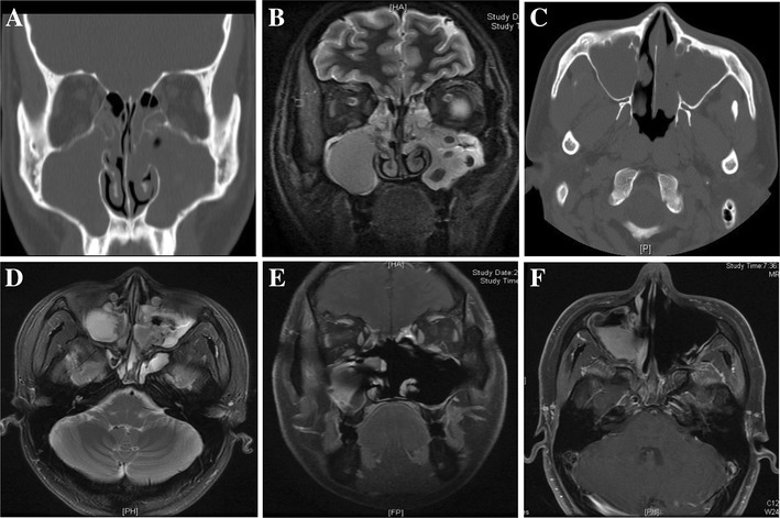 Intranasal endoscopic prelacrimal recess approach for maxillary sinus ...