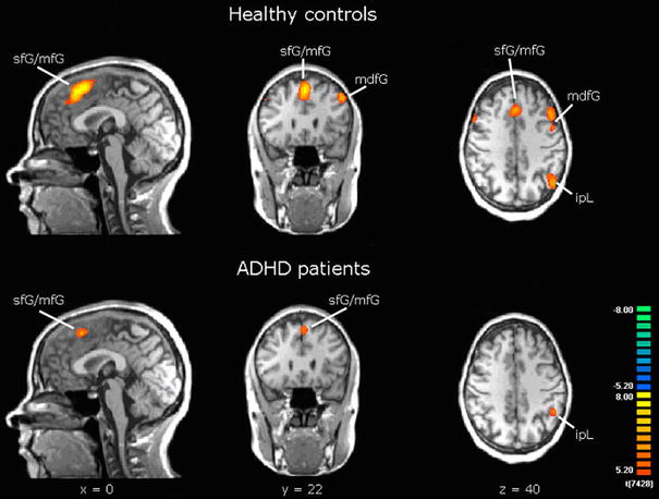 Neural correlates (ERP/fMRI) of voluntary selection in adult ADHD ...