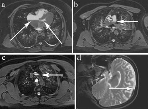 Postmortem imaging of blood and its characteristics using MSCT and MRI ...
