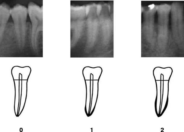Radiographic evaluation of Gustafson’s criteria for the purpose of ...