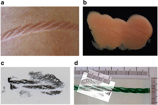 The persistence of ligature marks: towards a new protocol for victims ...