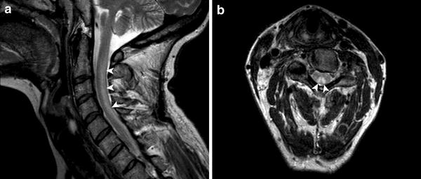 Copper deficiency myelopathy | SpringerLink