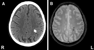 Isolated foot drop due to subcortical hemorrhage | SpringerLink