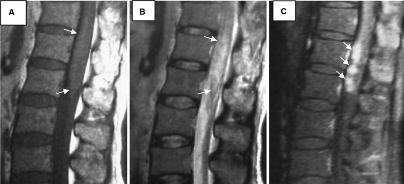 Neuroschistosomiasis | SpringerLink