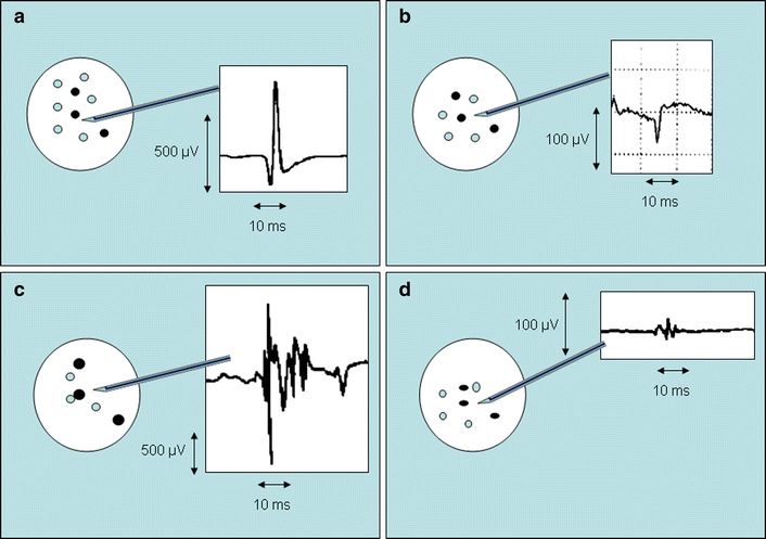 Techniques and applications of EMG: measuring motor units from ...