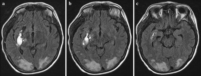 Posterior reversible encephalopathy syndrome | SpringerLink
