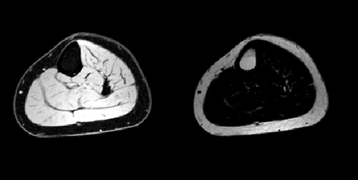 Quantifying fat replacement of muscle by quantitative MRI in muscular ...