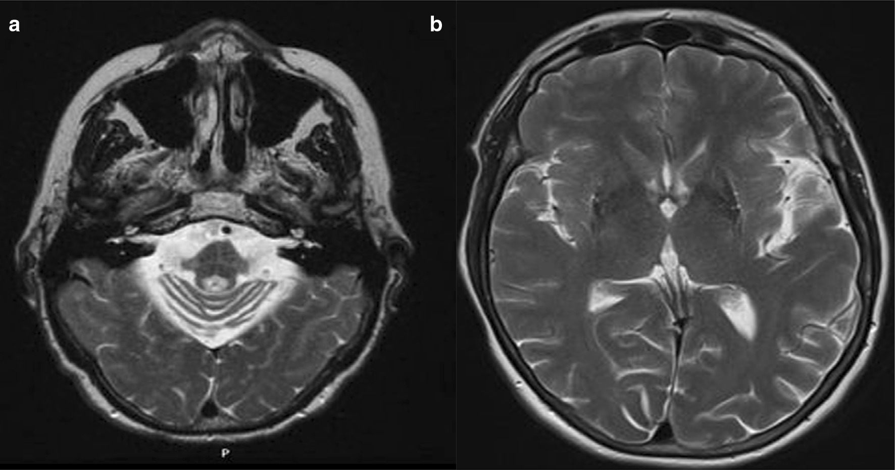 An update on advances in magnetic resonance imaging of multiple system atrophy | SpringerLink
