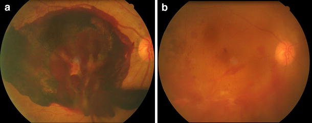 Intravitreal injection of bevacizumab and gas for diabetic premacular ...