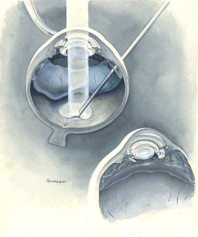One-port pars plana vitrectomy (by 25-G micro-incision) | SpringerLink