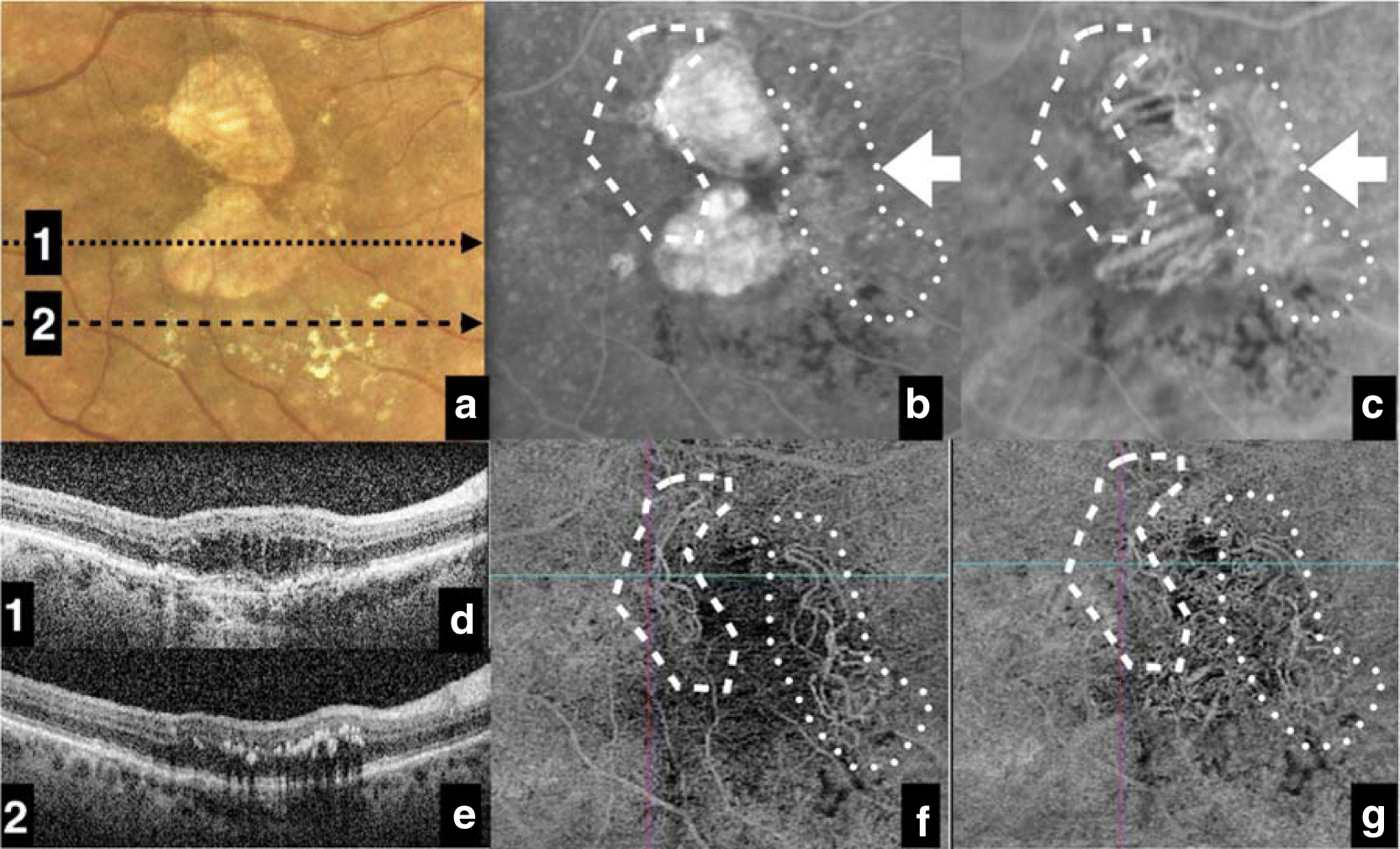 The role of OCT-A in retinal disease management | SpringerLink