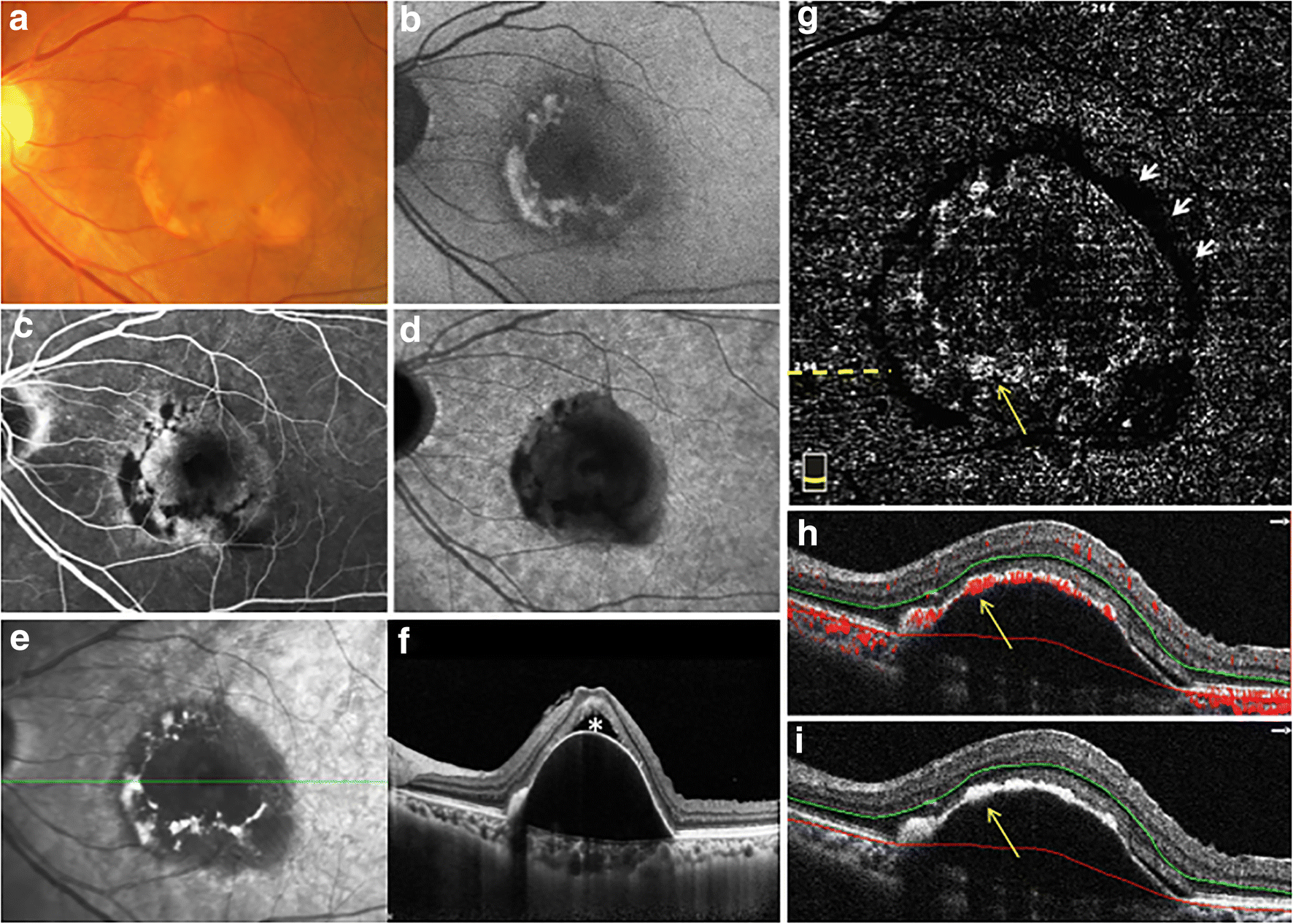 Retinal pigment epithelium hyperplasia overlying pigment epithelial ...