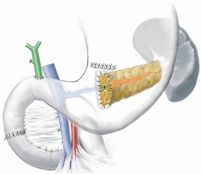 Duodenum-preserving total pancreatic head resection for cystic neoplasm ...