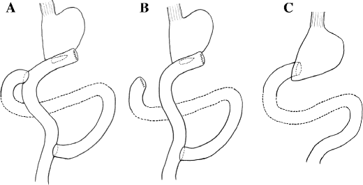 Double tract reconstruction after distal gastrectomy for gastric cancer ...