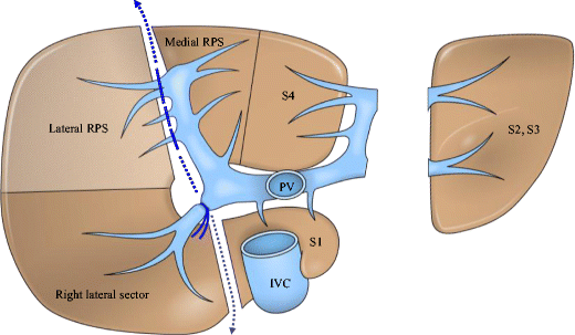 Modified ALPPS procedures: more safety through less invasive surgery ...