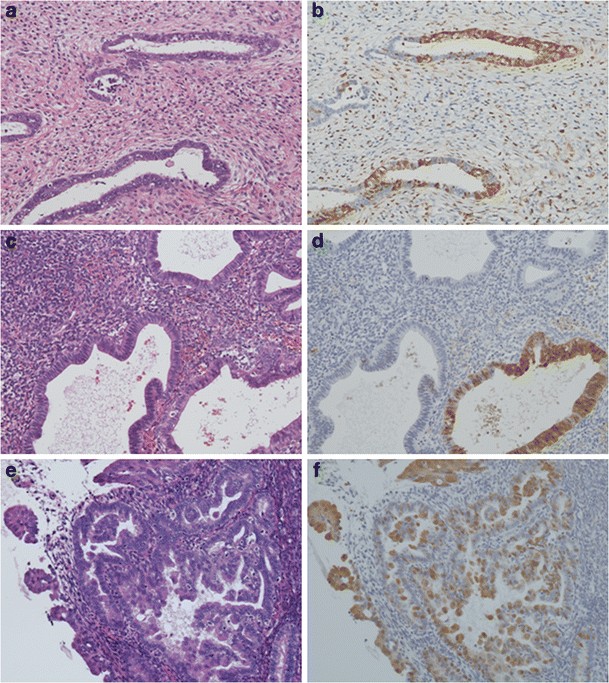 Stromal p16 expression differentiates endometrial polyp from ...