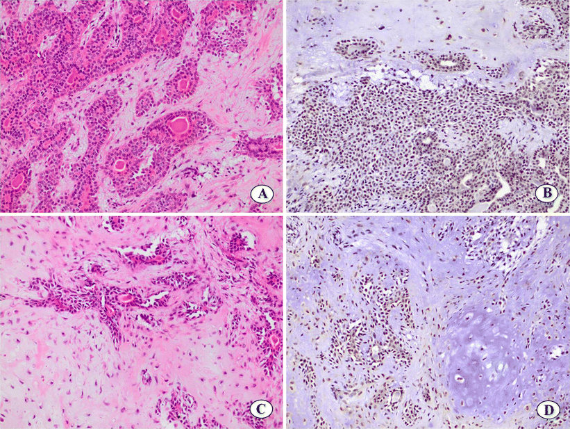 PLAG1 expression is maintained in recurrent pleomorphic adenoma ...