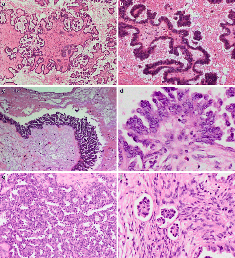 Ovarian borderline tumors in the 2014 WHO classification: evolving ...