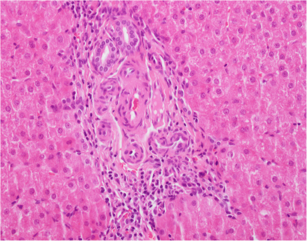 Histopathology of livers in patients with congenital portosystemic ...